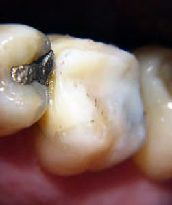 Dental/Herniated Disc Connection - ICNR